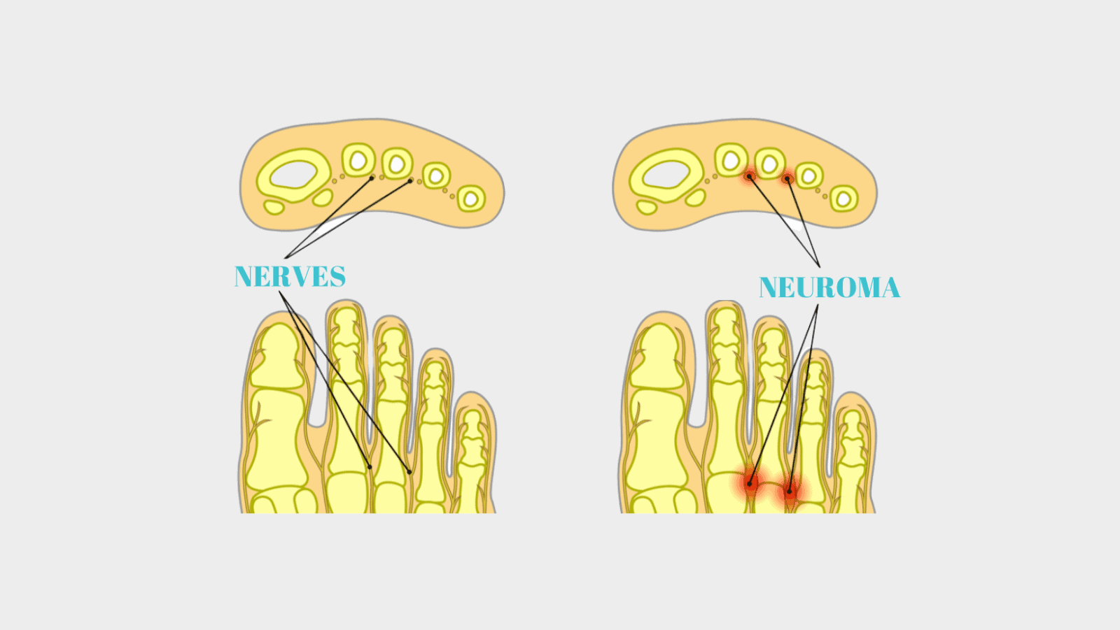 Morton's Neuroma Exercises | Morton's Neuroma Treatment Exercises