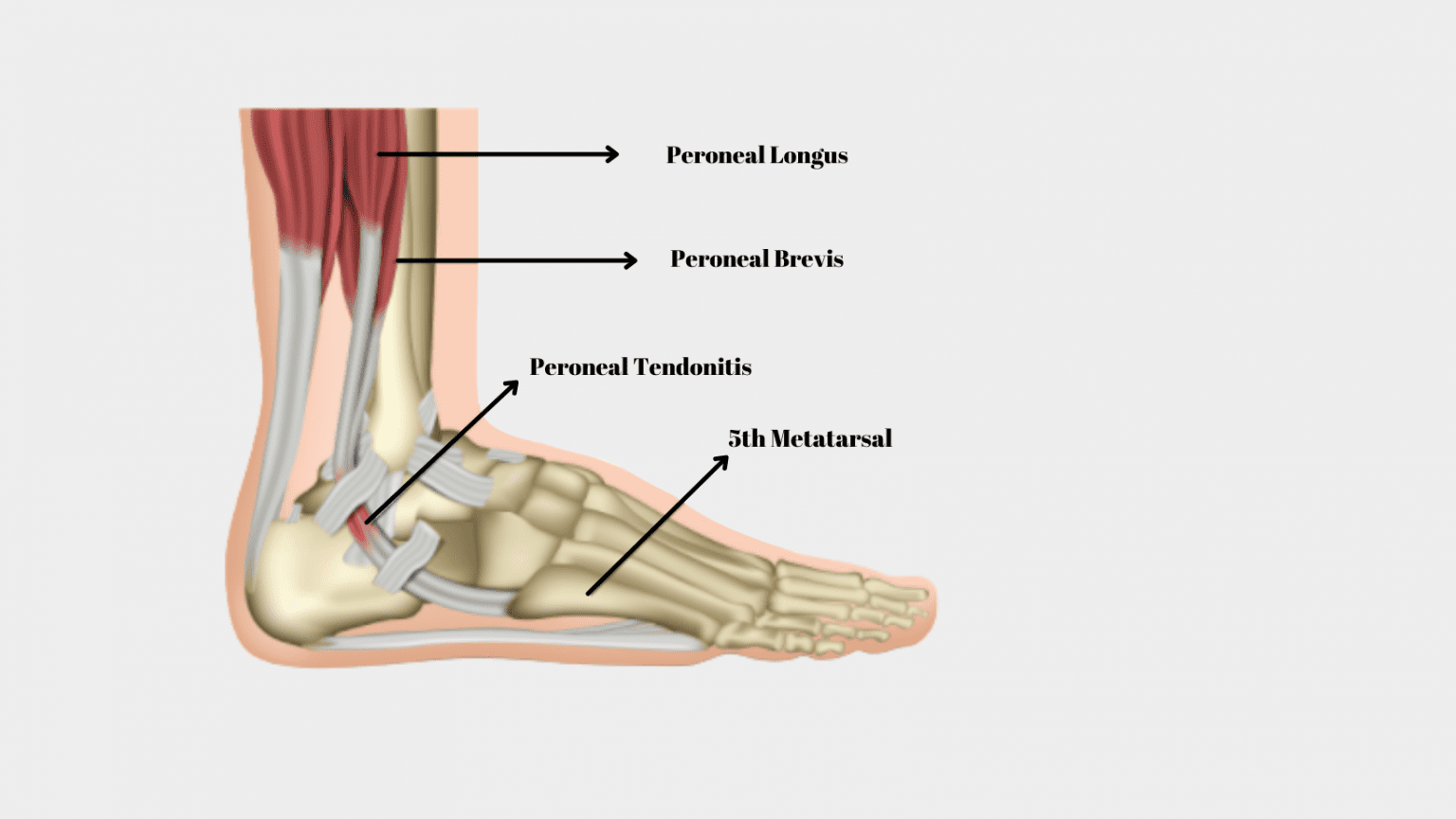 Peroneal Tendonitis: Symptoms and treatment for Peroneal Tendonitis