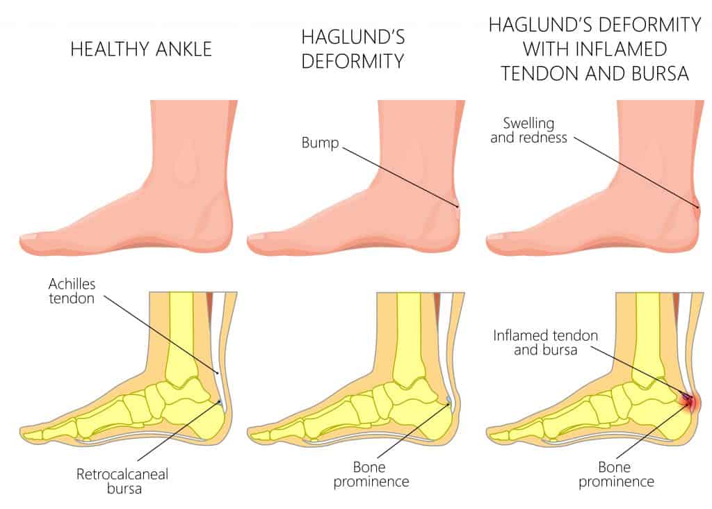 Insertional Achilles Tendonitis | Insertional Achilles Tendinopathy