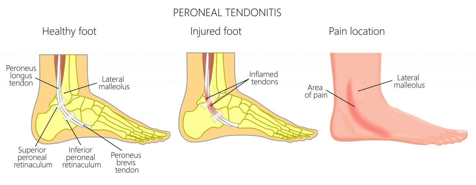 Peroneal Tendonitis: Symptoms, Causes and Treatment