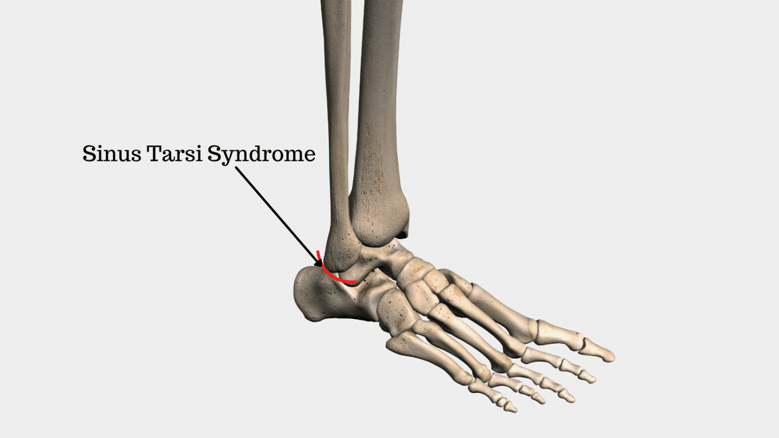 Sinus Tarsi Syndrome | How to treat Sinus Tarsi Syndrome