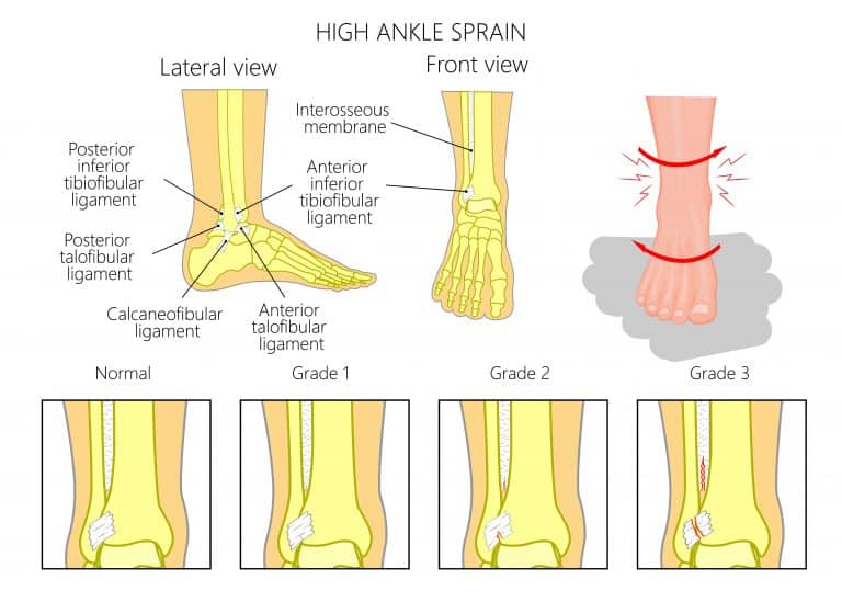 High Ankle Sprain | Explained by an Ankle Specialist