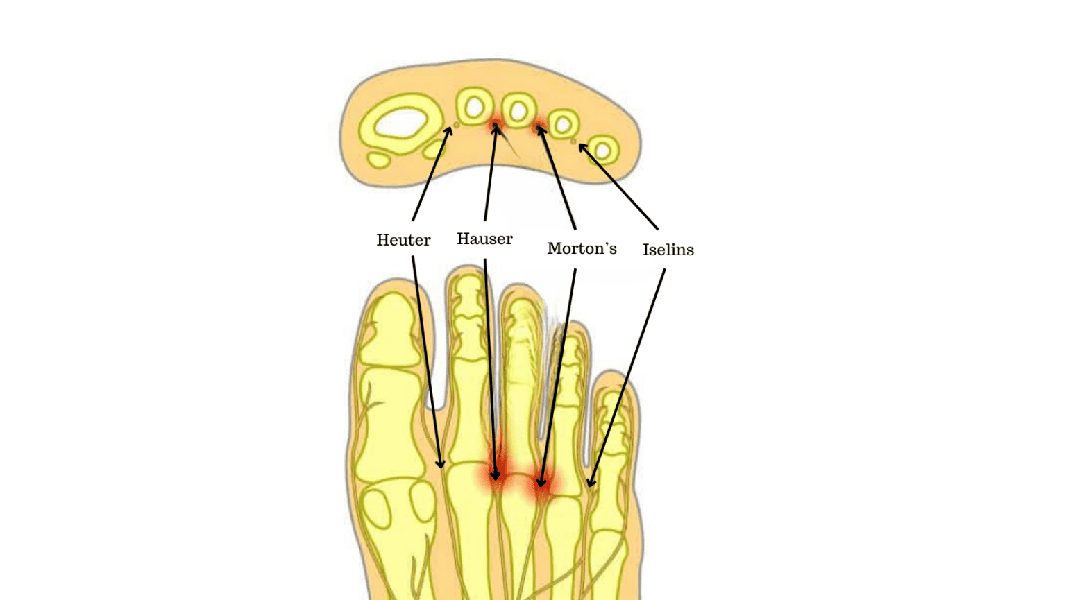 Morton's Neuroma: Diagnosis, Symptoms and Treatment