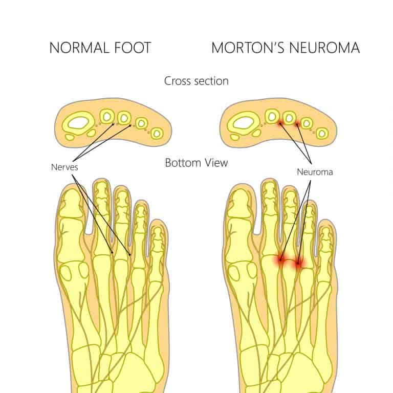 Morton's Neuroma: Diagnosis, Symptoms and Treatment