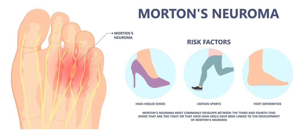 Morton's Neuroma: Diagnosis, Symptoms and Treatment