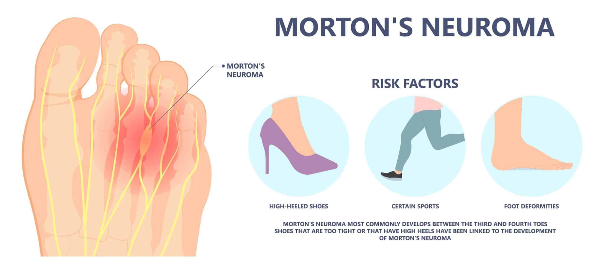 Morton's Neuroma: Diagnosis, Symptoms and Treatment