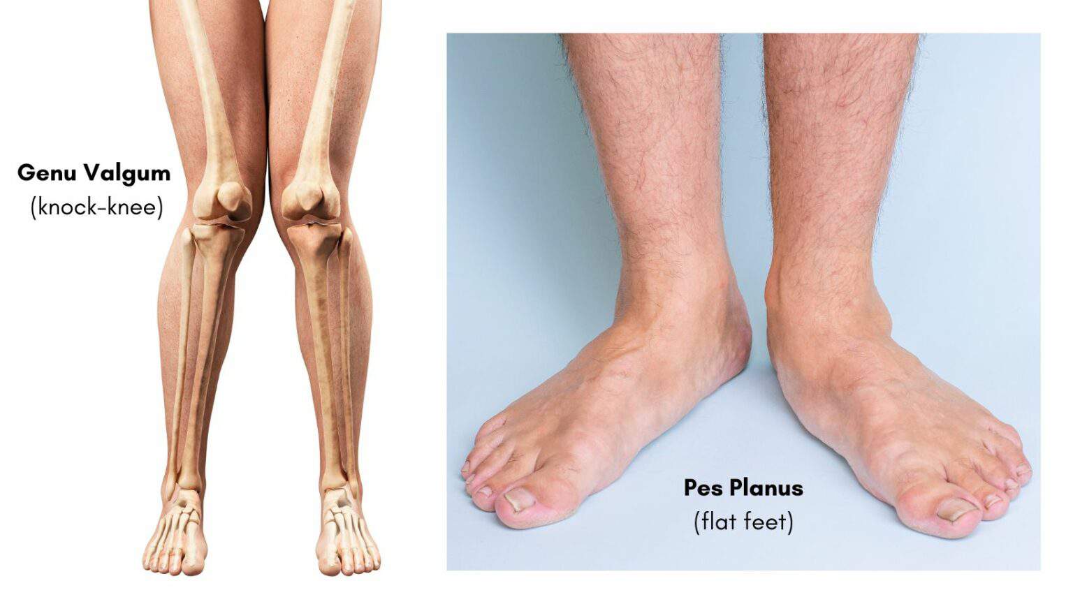 Pes Anserine Bursitis | Anatomy, Symptoms and Diagnosis