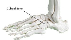 Cuboid Fracture | Cuboid Bone Fracture: Symptoms and Treatment