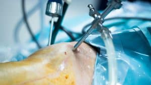 Lateral Meniscus Tear Treatment | Physical Therapy and Surgical