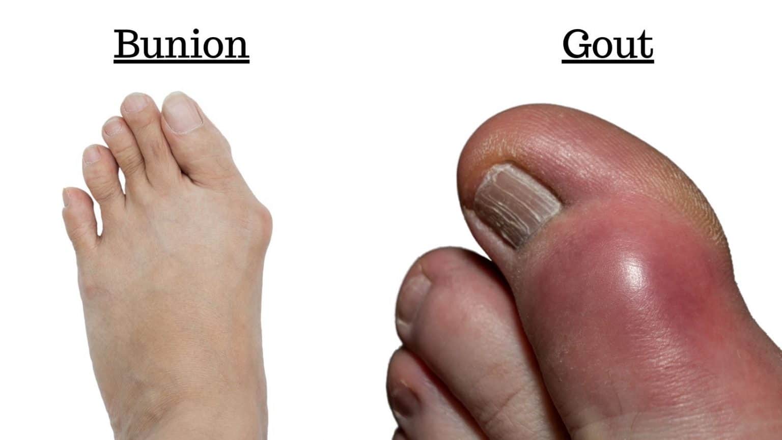 Corn vs Bunion | Bunion vs Callus | Causes of Big Toe Pain