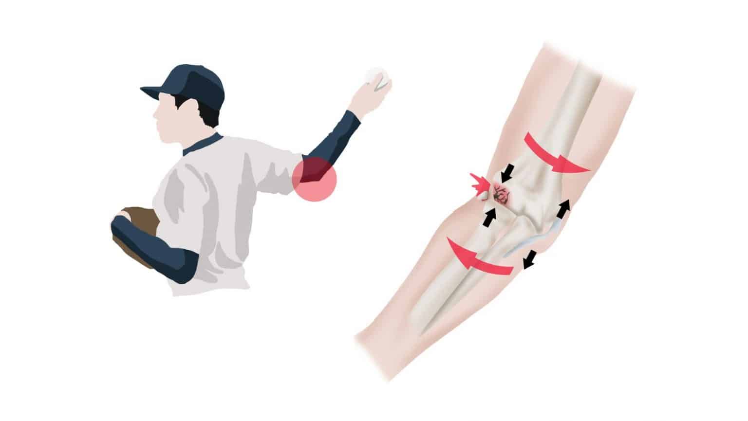 Osteochondritis Dissecans | Pathology, symptoms and diagnosis