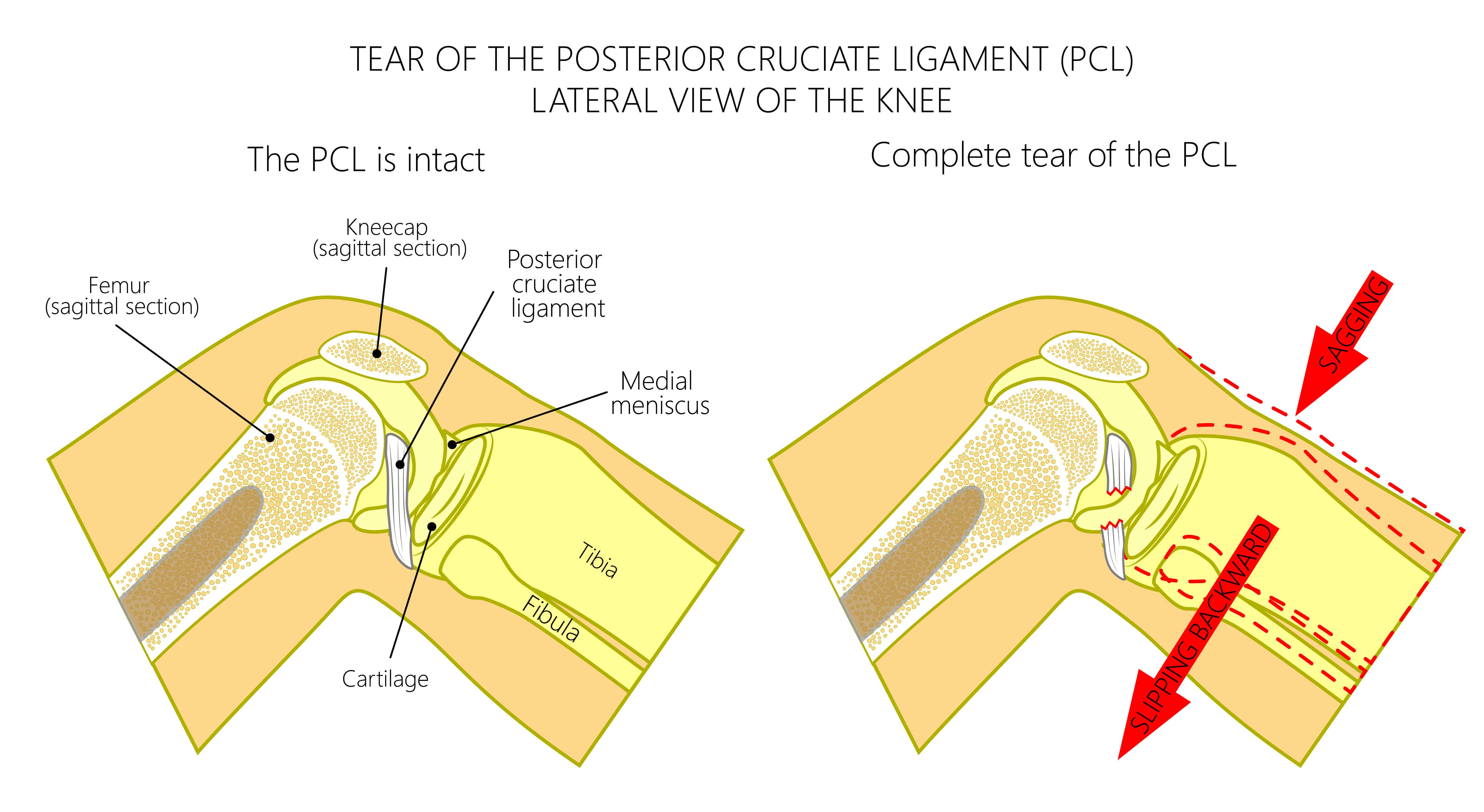 PCL Tear Frequently Asked Questions PCL Tear Frequently Asked Questions