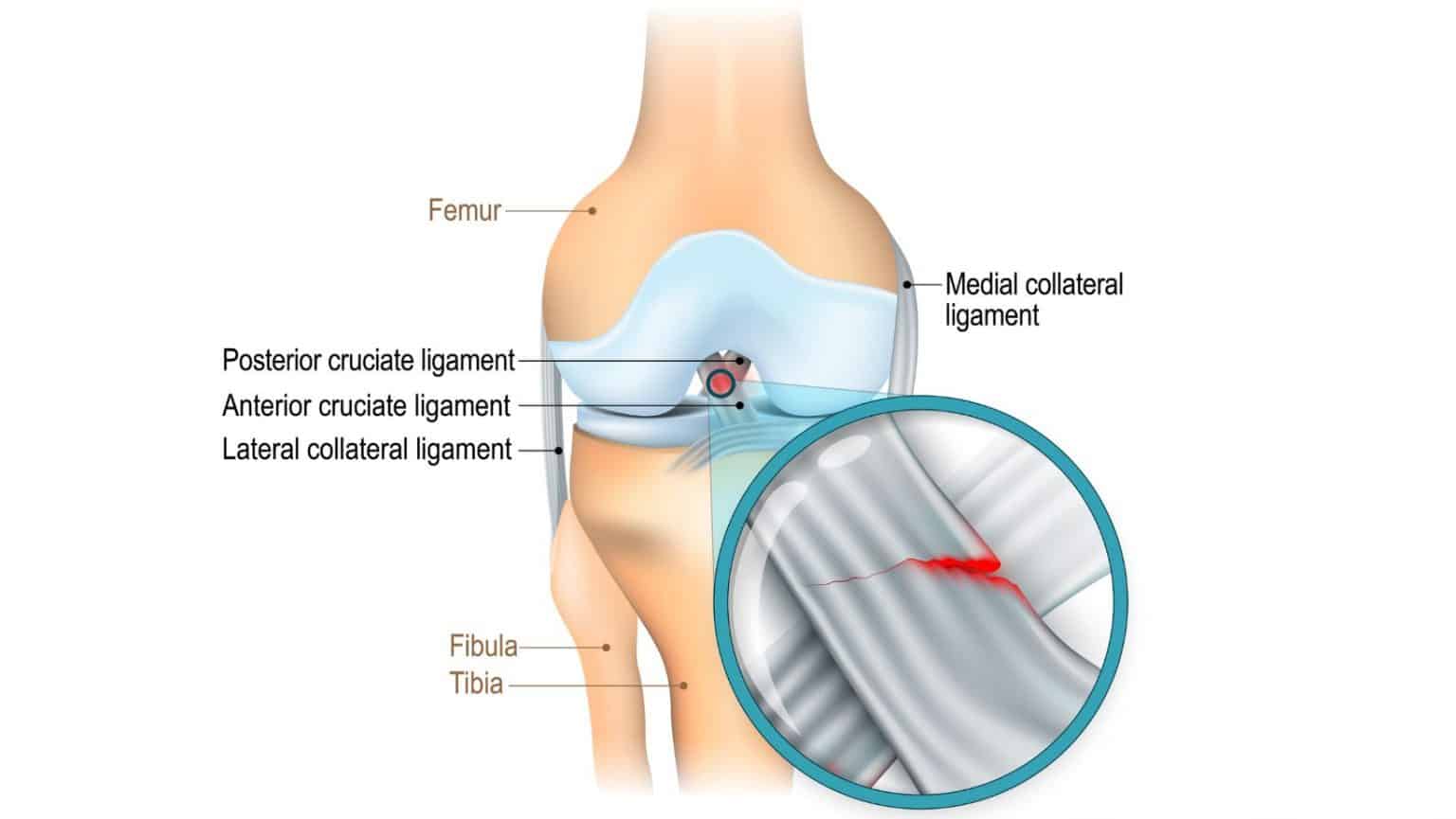 ACL Sprain | Anterior Cruciate Ligament Sprains
