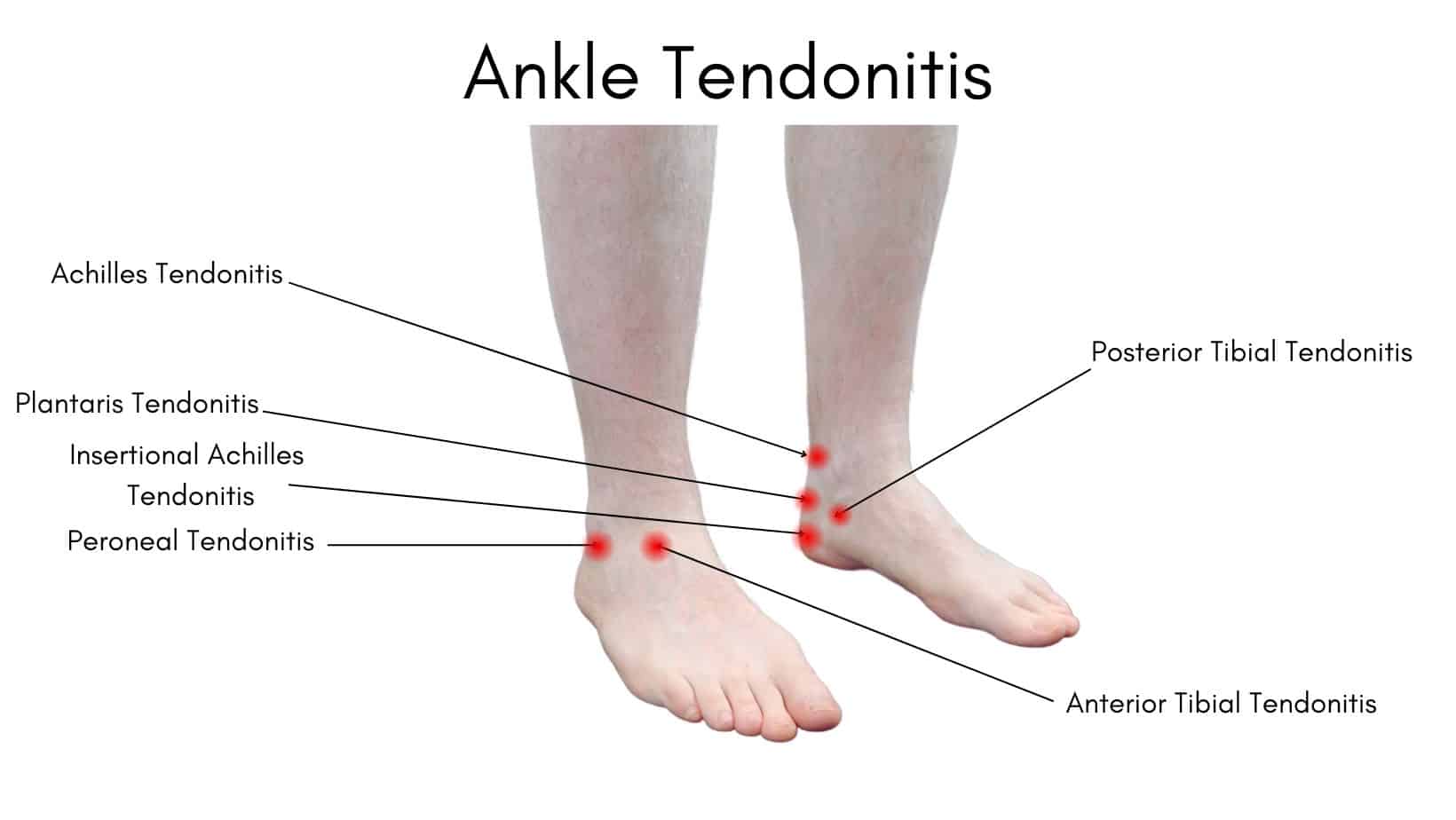 Peroneal Tendonitis