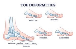 Mallet Toe: Symptoms & Treatment from a Foot Specialist