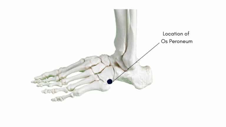 Os Peroneum Syndrome: Get the Answers from a Foot Specialist