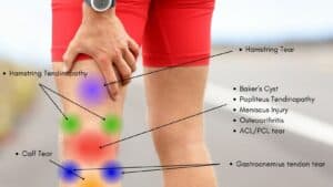 Knee Pain Location Chart | Learn the Pain Location of Knee Injuries