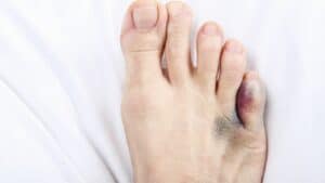 Sprained Toe: Diagnosis and Treamtment by a Foot Specialist
