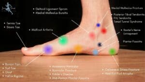 Foot Pain Chart: Top of Foot, Side and Front of Foot Pain Chart