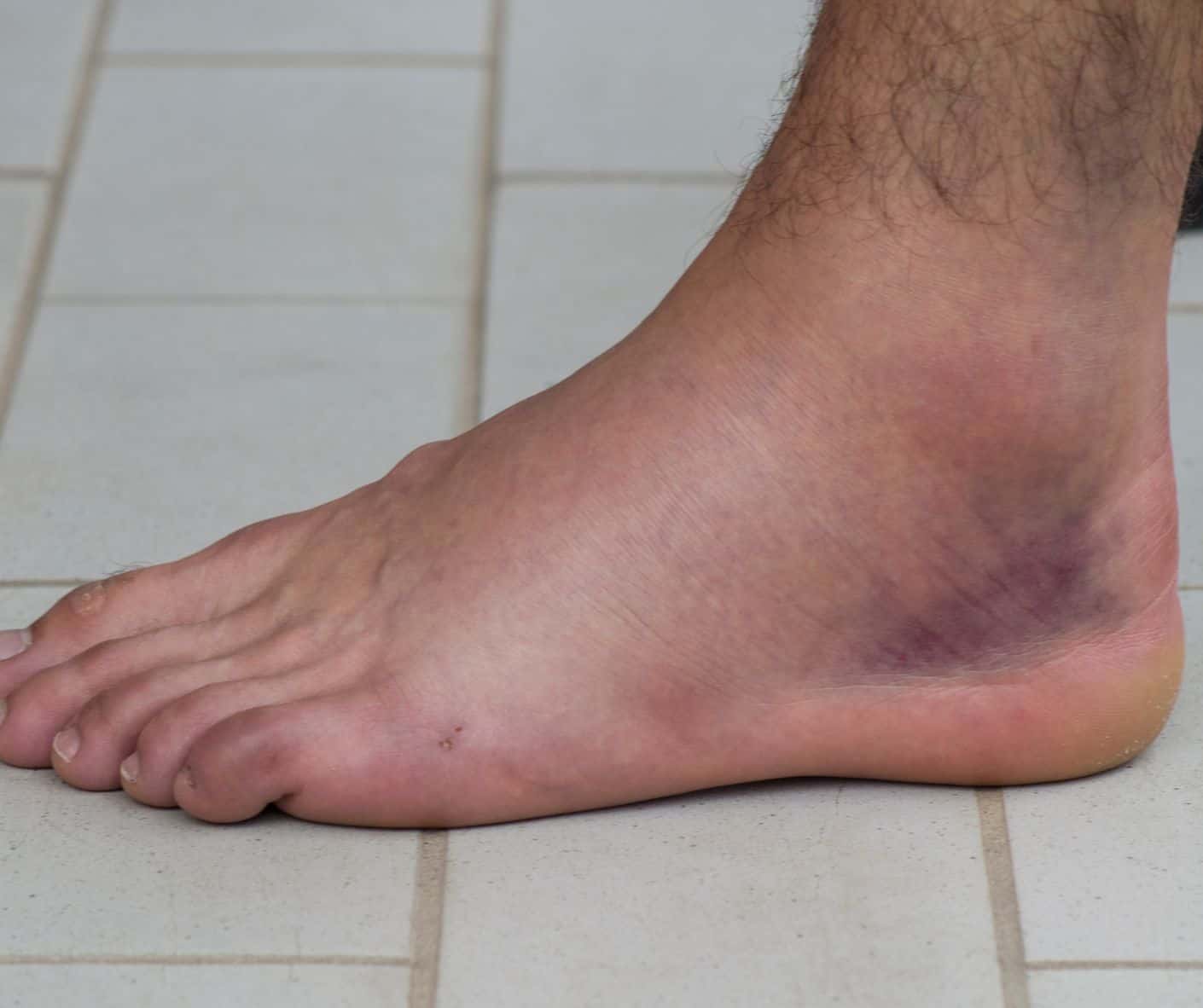 Sprained Ankle Recovery Time Explained By An Ankle Specialist