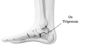 Os Trigonum | Back of Ankle Pain Explained by a Foot Specialist