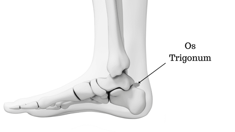 Os Trigonum | Back of Ankle Pain Explained by a Foot Specialist