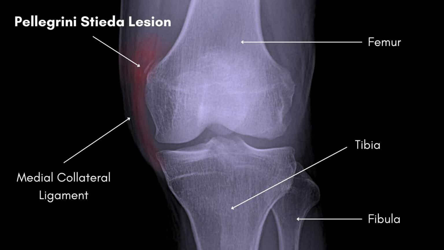Pellegrini Stieda Syndrome | Pellegrini Stieda Lesion