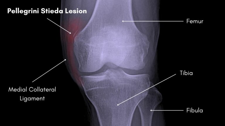 Pellegrini Stieda Syndrome | Pellegrini Stieda Lesion