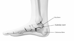 Subtalar Joint Arthritis: explained by a Foot Specialist