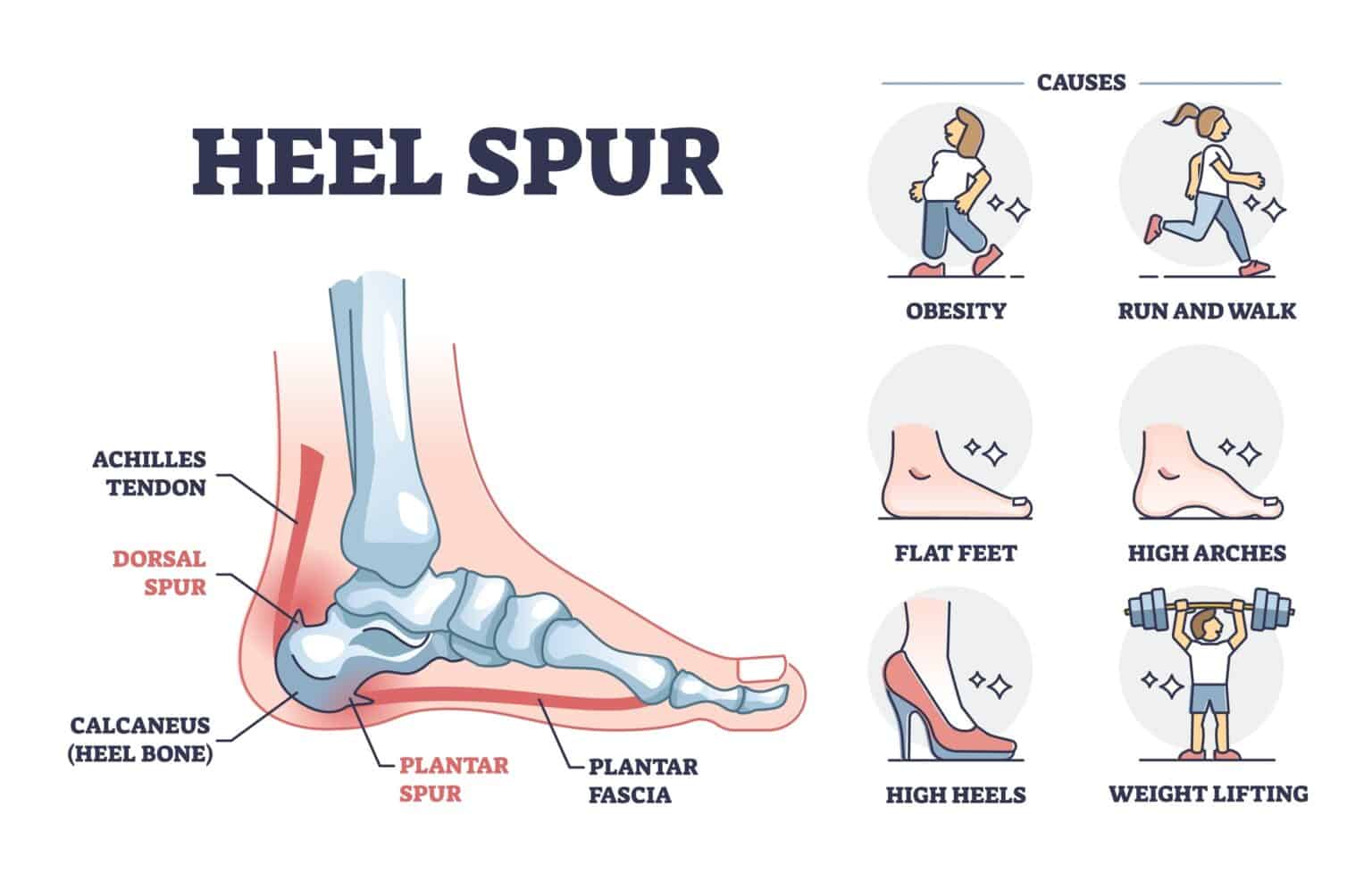 Heel Spur Treatment by a Physical Therapist including Exercises