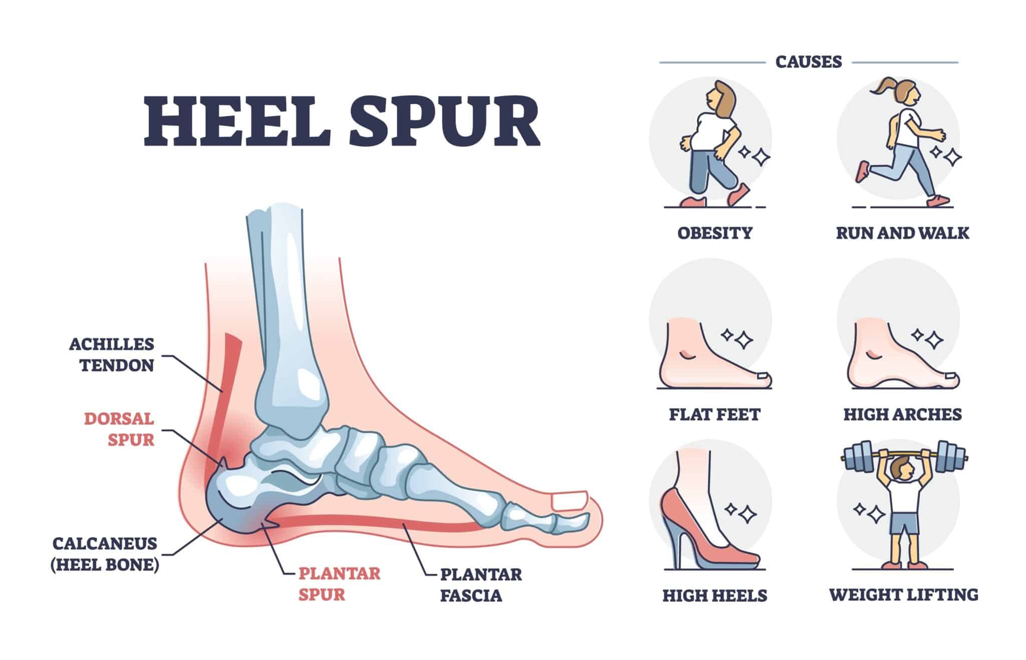 Heel Spur Treatment By A Physical Therapist Including Exercises