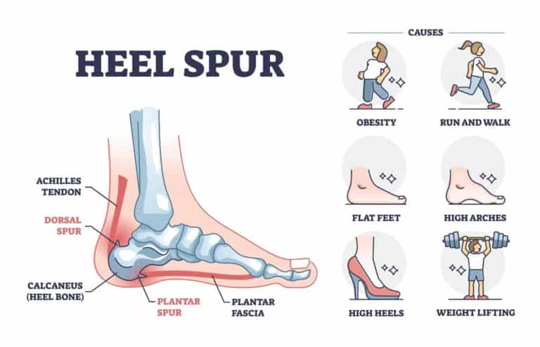 Heel Spur Treatment by a Physical Therapist including Exercises