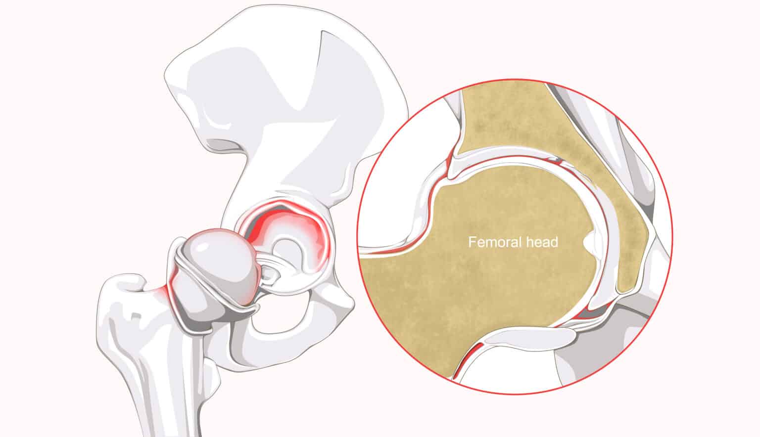 Hip Labral Tear | Anatomy and Symptoms